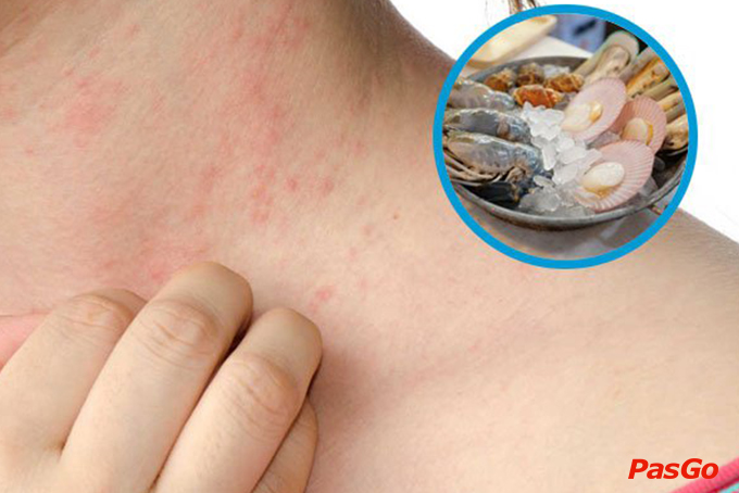 Unraveling the Mystery Behind Seafood Buffet Food Poisoning